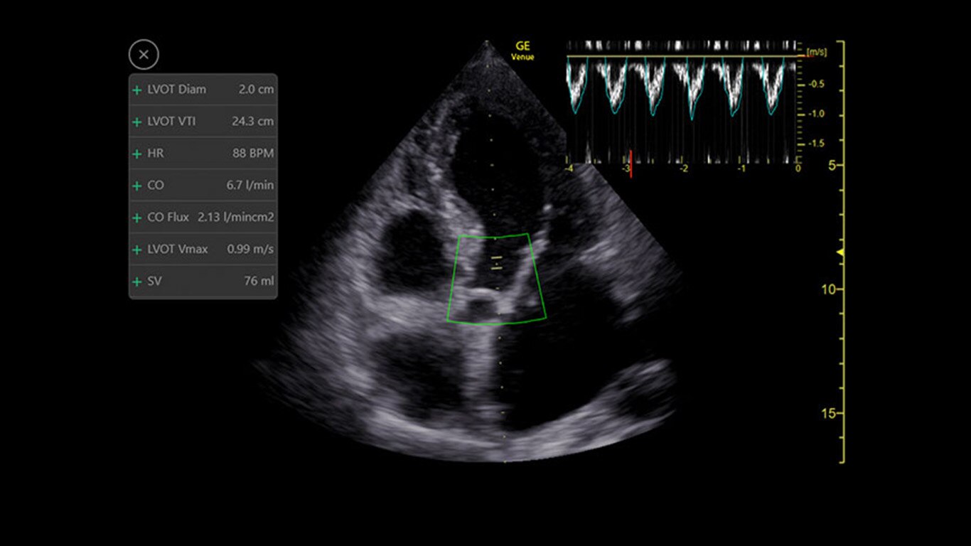 Venue Point of Care Ultrasound for Emergency Care | GE HealthCare ...